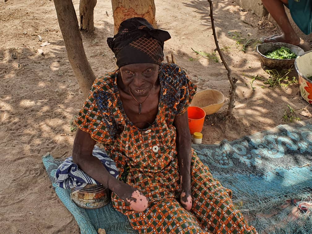 Story of the 80-year-old leper abandoned by her children - MyJoyOnline