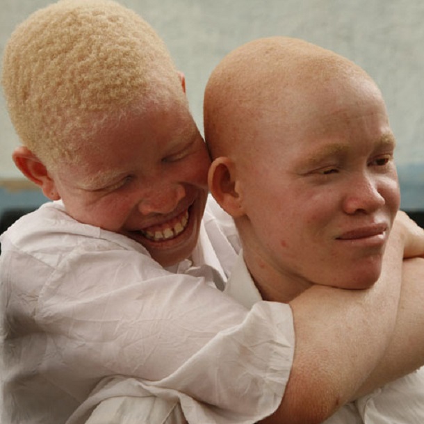 Implement Regional Albinism Action Plan – Stakeholders urge government ...