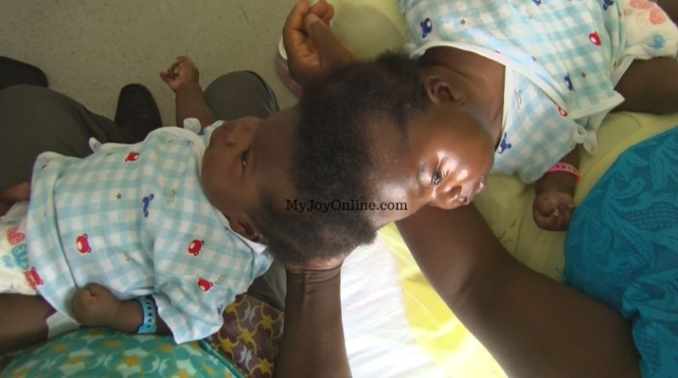 Amasaman MP donates towards surgery for Siamese twins, announces ...